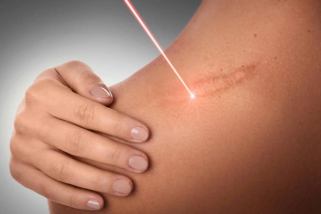 Scar Revision In Old Bridge, NJ | Scar Removal Treatment